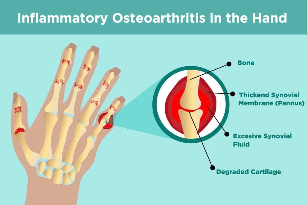 Go Away, Hand OA | Wurth Chiropractic